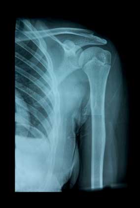 Acromioclavicular Joint Separation | AC Dislocation
