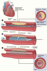 PTCA | Angioplasty Coronary (Heart) Stents, Cardiac Catheterization