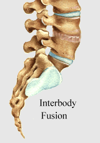 Lumbar Spinal Fusion Surgery | instrumented, anterior, posterior, cage