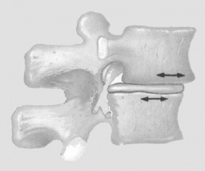 Causes Lumbar Back Pain-Herniated Disk Spondylolysis Spondylolisthesis