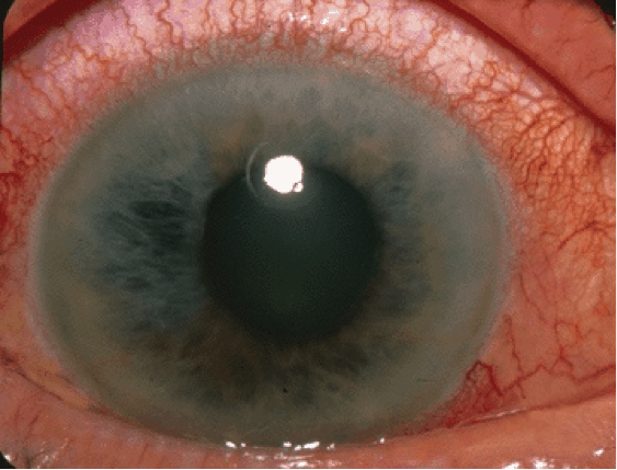 Glaucoma Introduction and Description - Healthpages.org