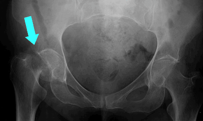 Hip Fracture in Older Adults