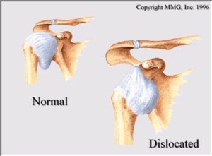 Shoulder Instability